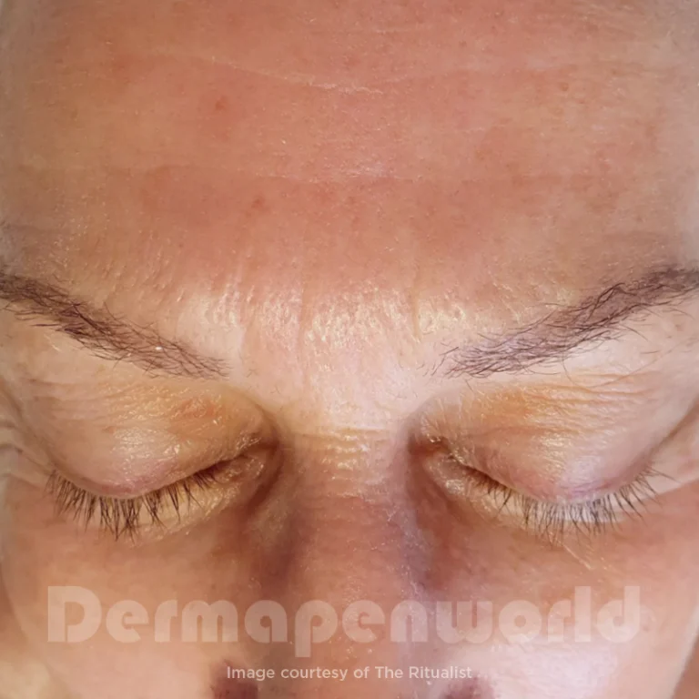 Microneedling - Dr Tanov Aesthetics