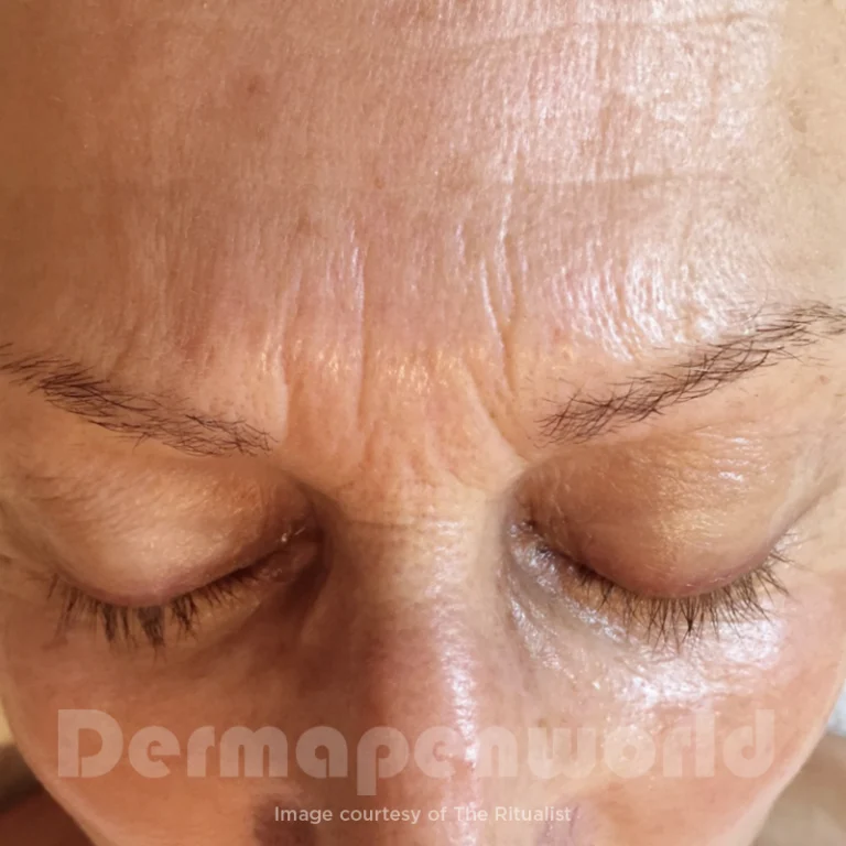 Microneedling - Dr Tanov Aesthetics